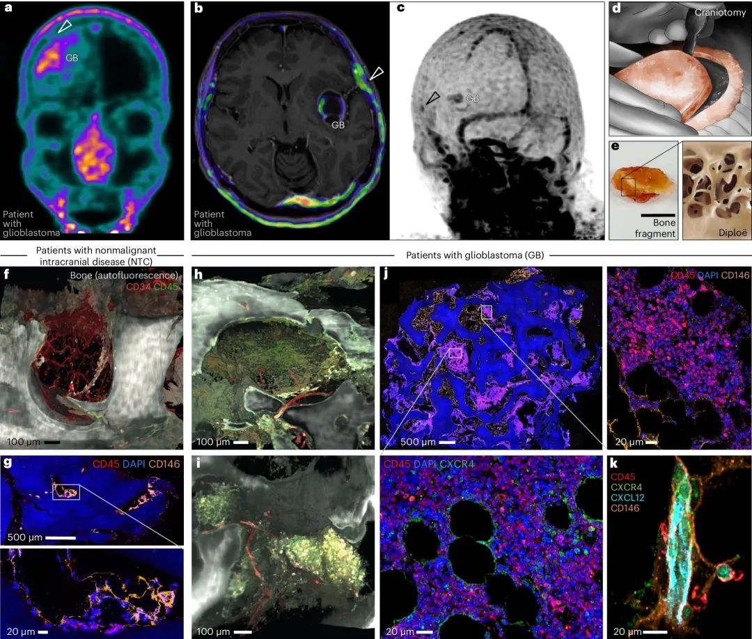 Nature Medicine | scRNA-seq揭示颅骨中的CD8+T细胞具有持久抗胶质母细胞瘤作用 - 单细胞测序网