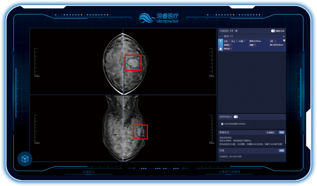 重磅！国家药监局颁发首张乳腺AI产品NMPA三类证 - 早筛网